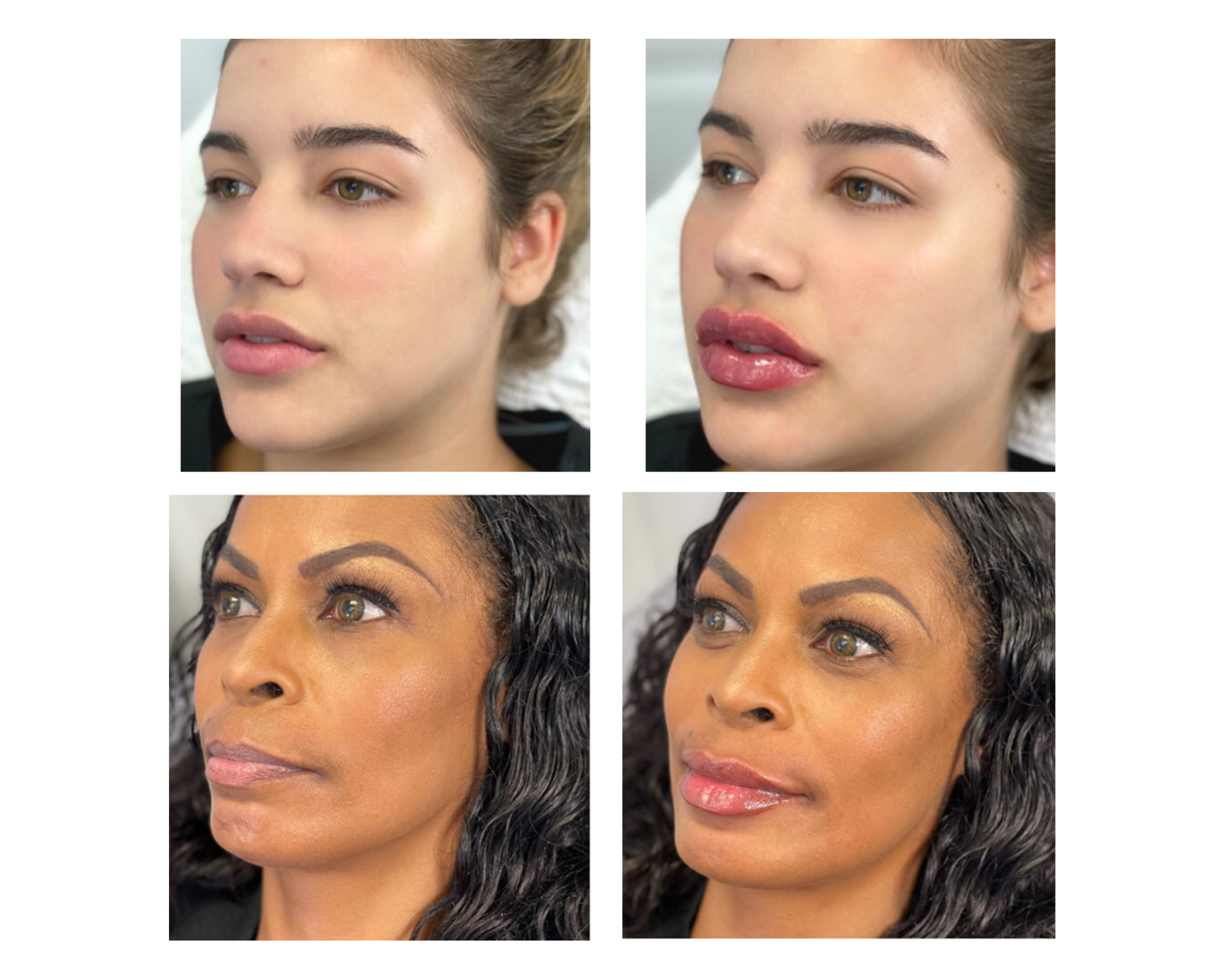 Lip Sculpting Tampa | Lip Fillers Tampa Bay, FL