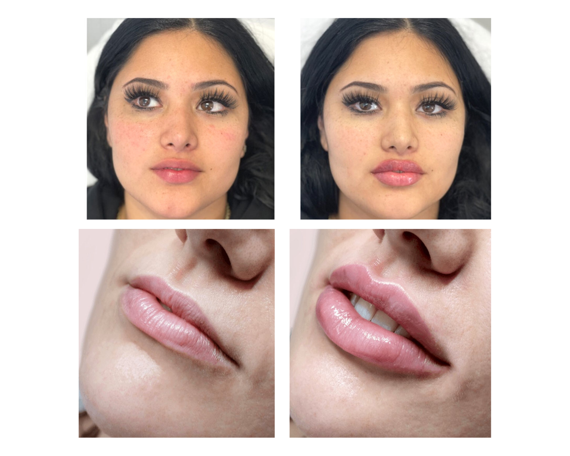 Lip Sculpting Tampa | Lip Fillers Tampa Bay, FL
